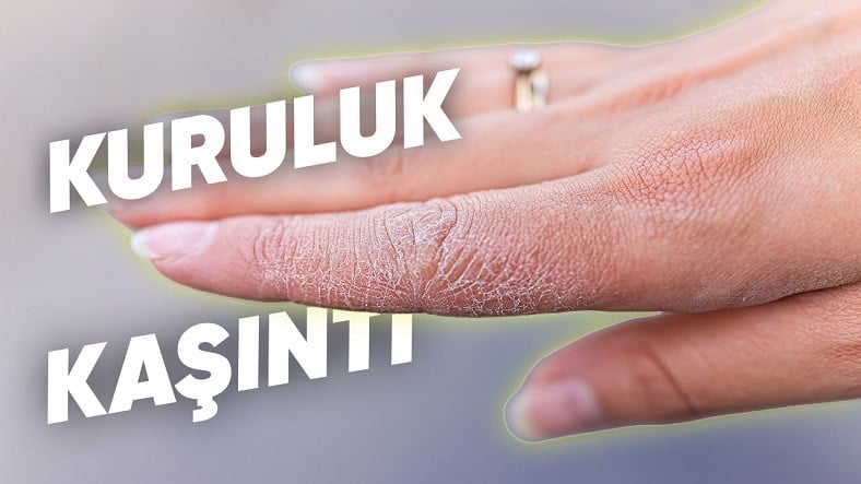 Egzama Olarak Bilinen Atopik Dermatit Nedir, Nasıl Geçer?
